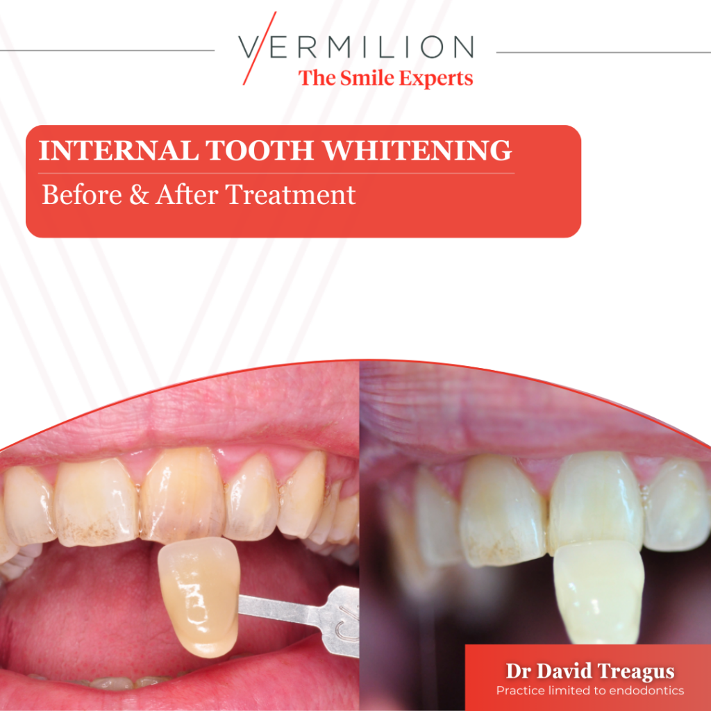 Effective Solutions for Darkened Teeth: Internal Tooth Whitening ...